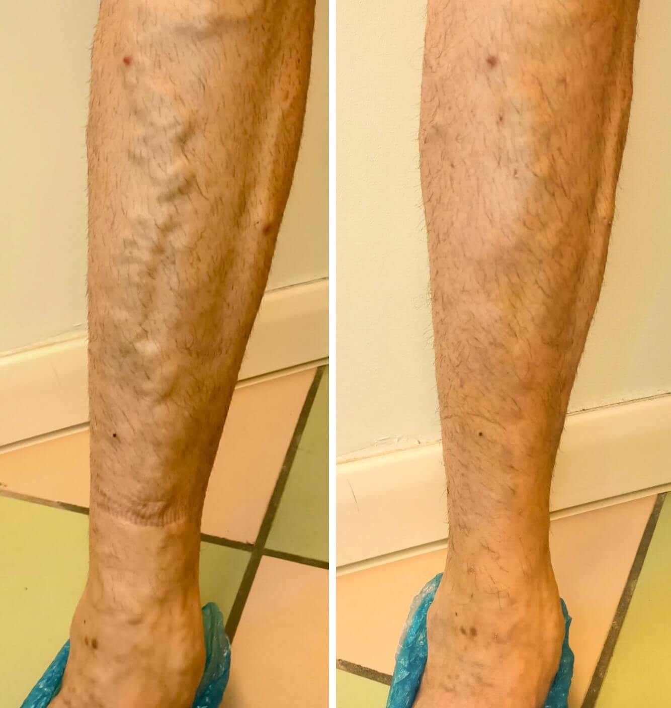 VariCaps MAX: La crema Naturale numero 1 contro le Vene Varicose ...